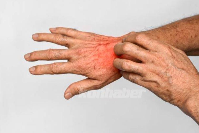 Uyuz İlaçları Nelerdir? Uyuz İlaçları En Etkili Tedavi mi?